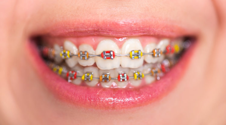 Complete Guide to Color Braces in Los Angeles, CA – Smile Angels of ...