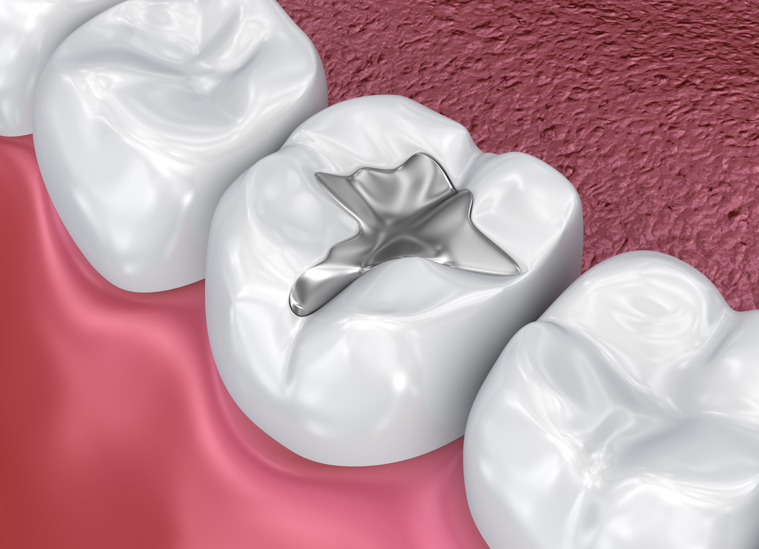 Safe Mercury Removal (SMART Protocol): Your Essential Guide to Costs ...