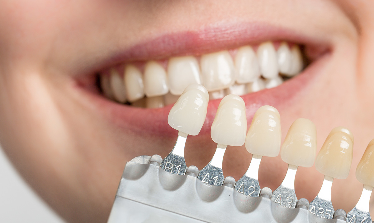 when Should You Consider Veneers | Smile Angels of beverly Hills