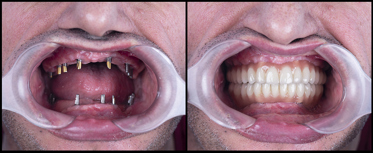 I Have No Teeth What Are My Options Smile Angels Of Beverly Hills I Have No Teeth What Are My Options Smile Angels Of Beverly Hills