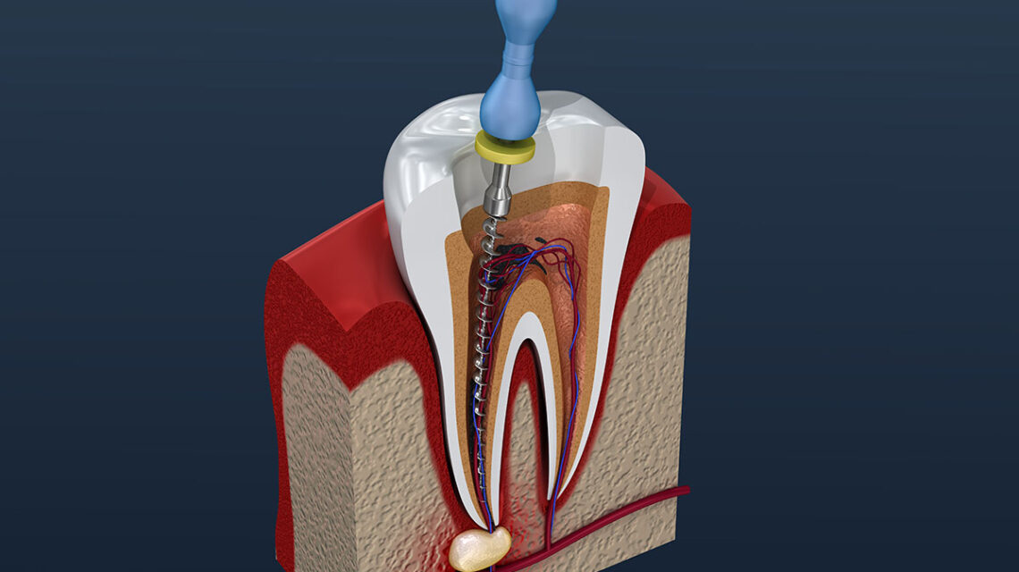 Do You Always Need A Crown After Root Canal Smile Angels Of Beverly Hills