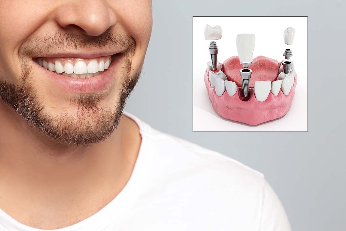 Are Dental implants Safe | Smile Angels of beverly Hills