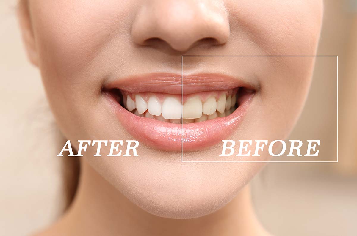 What is the minimum age for Teeth Whitening - Smile Angels of Beverly Hills