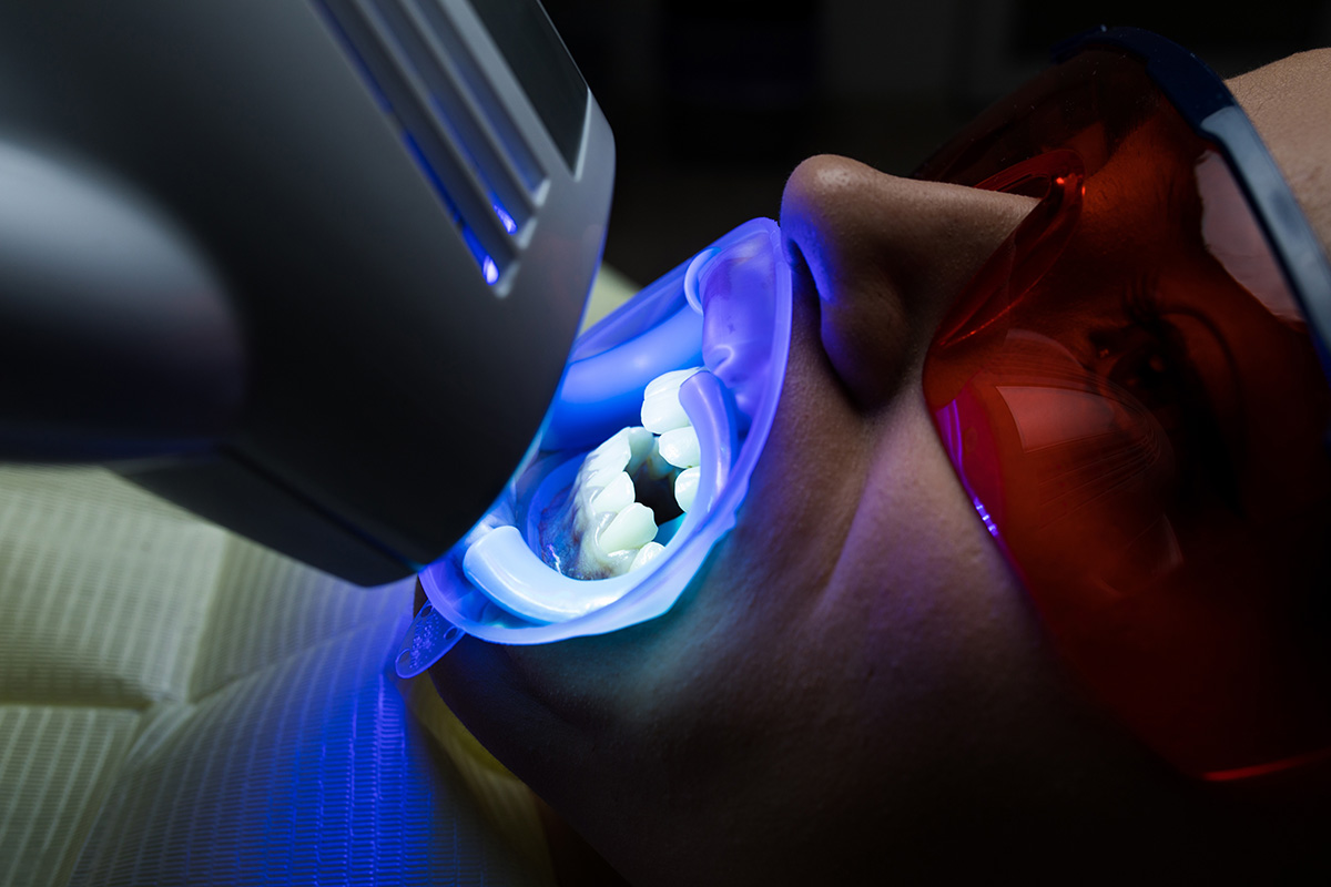 Do Teeth Whitening Really Work? | Smile Angels of beverly Hills